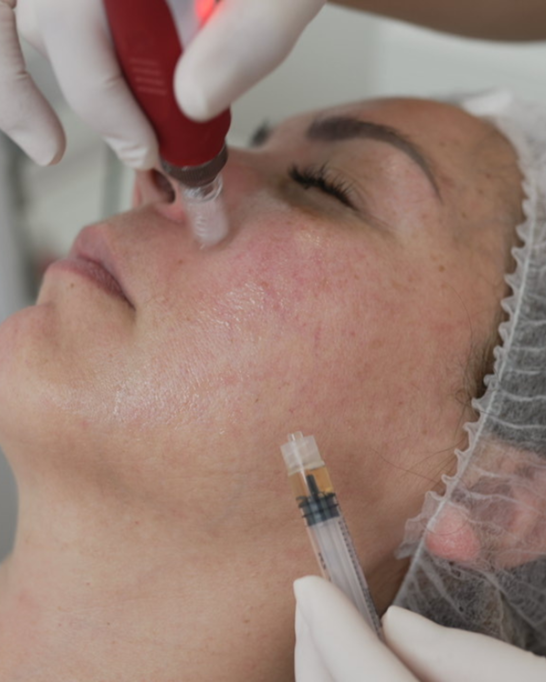 Protocolo con Microneedling (Dermapen) – Medilight Academy